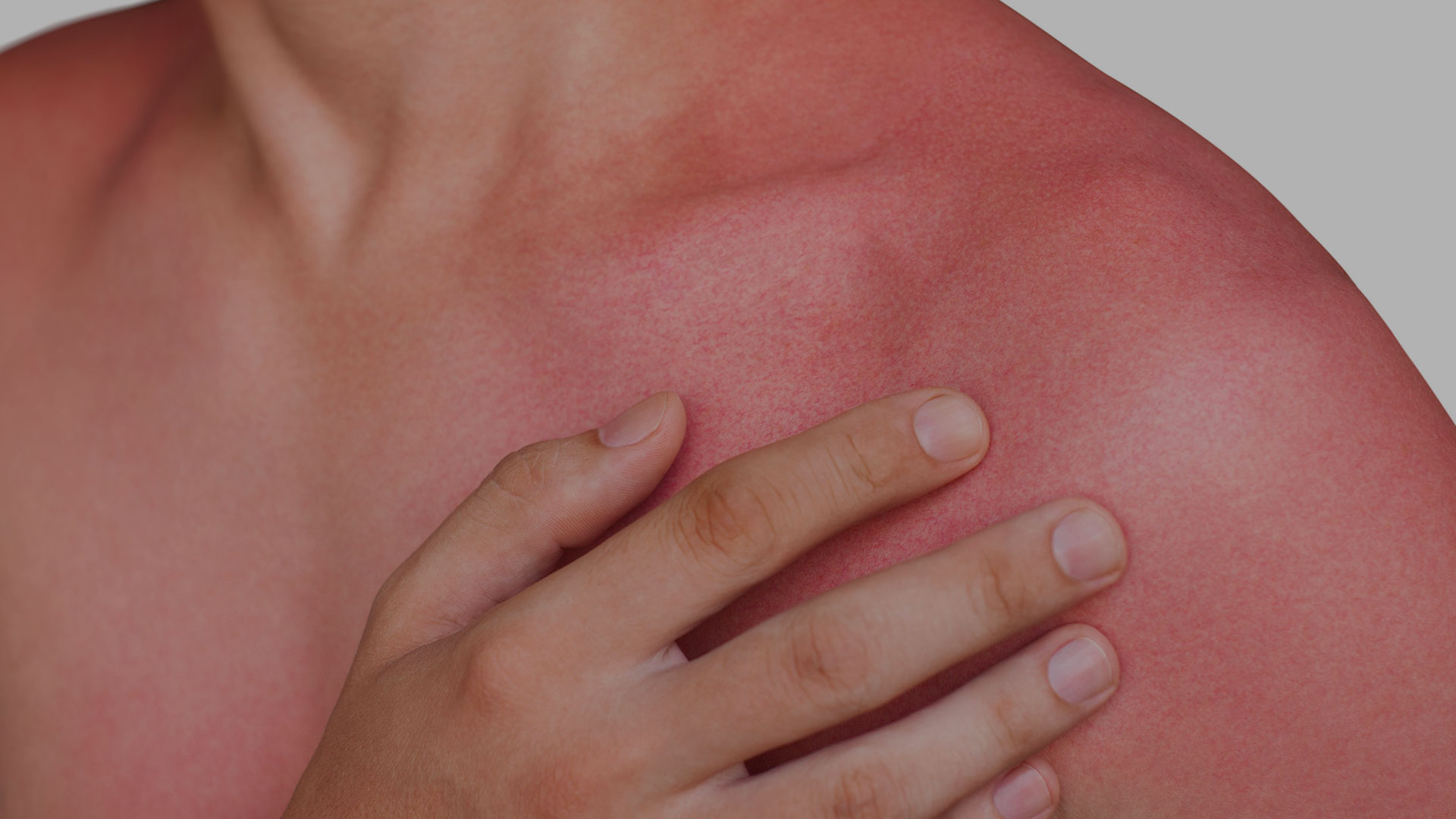 Au apărut primele cazuri de arsuri solare - Caută Sănătate